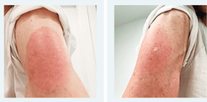 Doctors report large skin rashes appeared in 12 patients in delayed ...